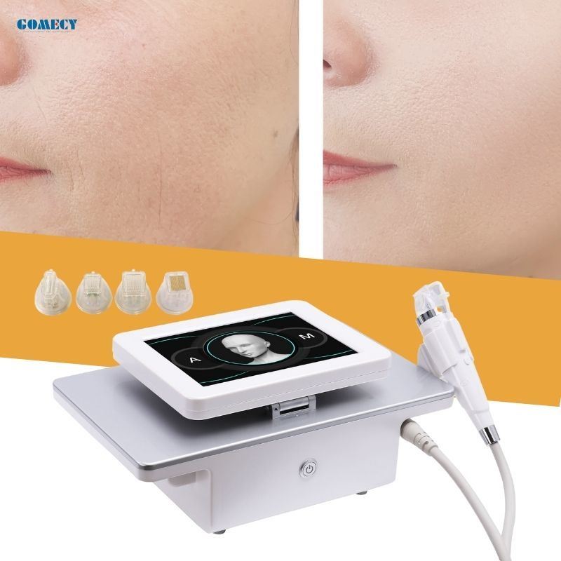 Fractional Microneedling Radio Frequency Machine for Pore Minimizing ...