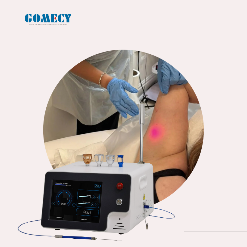Triple Wavelength Diode Laser System for Vascular Removal Lipolysis ...