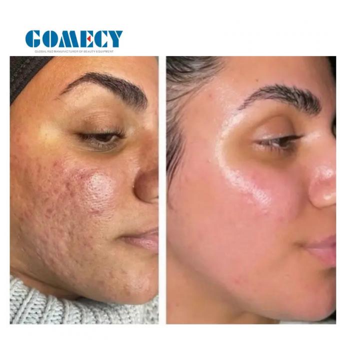 Radiofrecuencia Fractional RF Microneedling Machine with 2 Handles